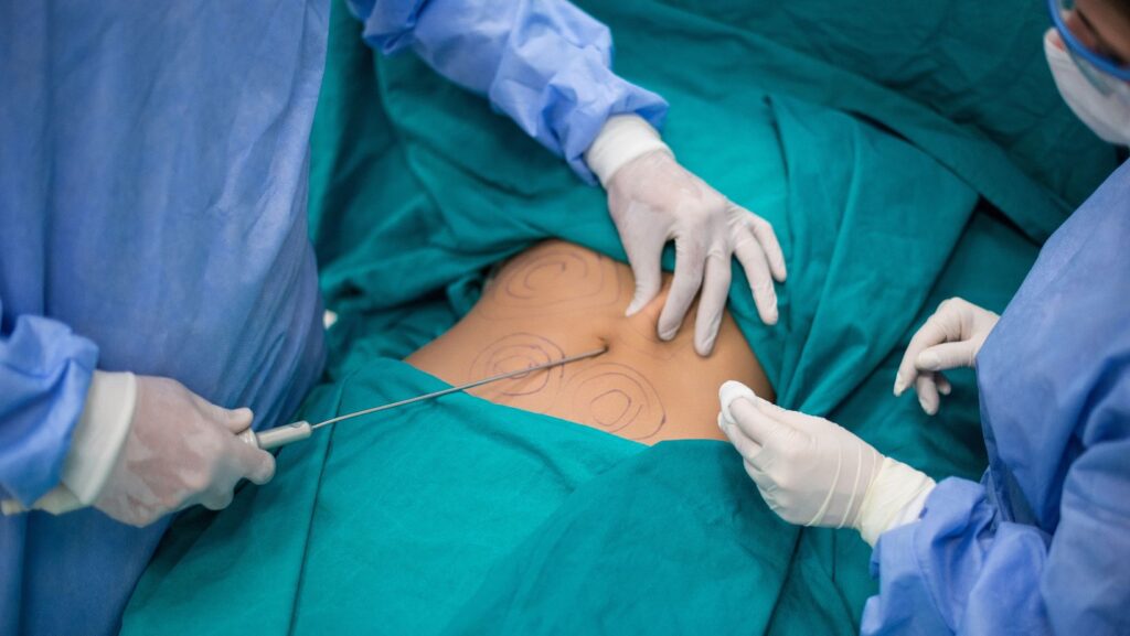 Lipo 360: Benefits, Procedure, and Recovery Explained - Greenheal